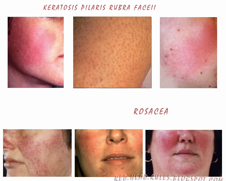 Rosacea czy KPRF? | red head rules