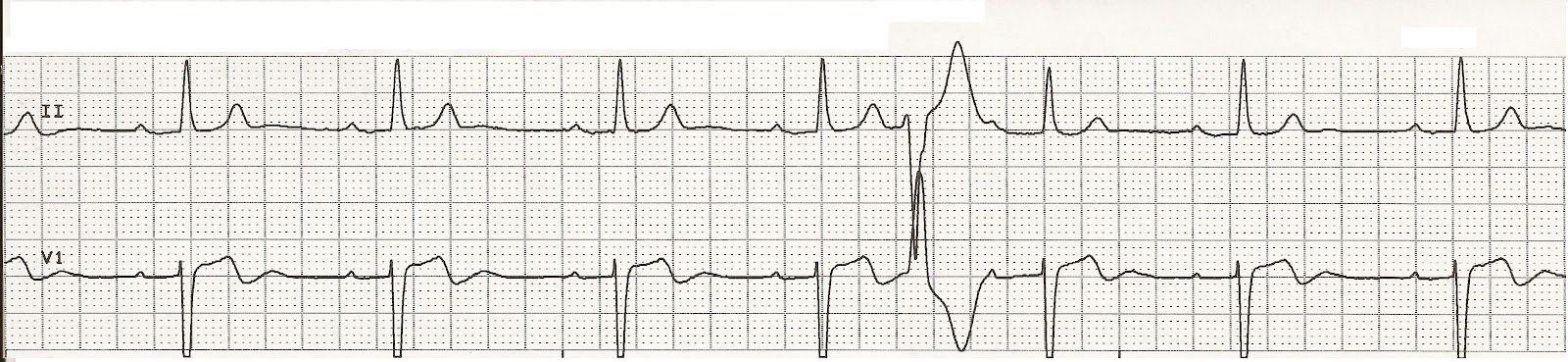 EKG Rhythm Strip Quiz 57: Ectopic Beats