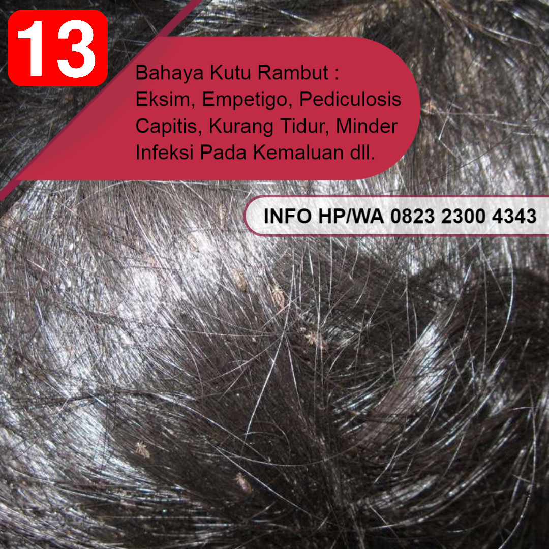 cara menghilangkan kutu rambut dan telurnya secara alami tanpa merusak ...