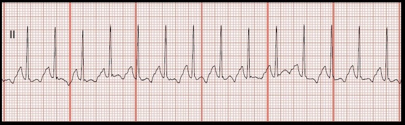 Practice Rhythm Strips 259