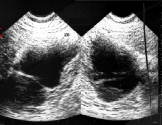 ecografie imagini medicina renal Renal nativ Hidronefroza | Terapii ...