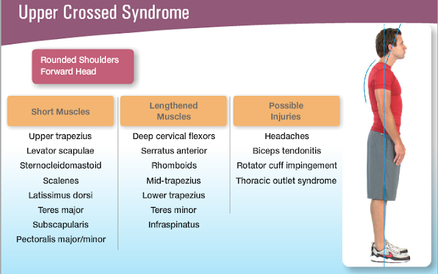 Upper And Lower Cross Syndrome