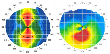 Keratoconus Is Much More Prevalent Than We Thought - Eyedolatry