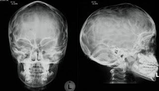 KESEHATAN: X-RAY FOTO SCADEL AP/LATERAL