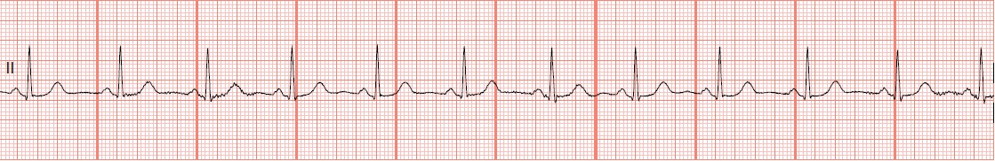 Basic ECG Rhythms