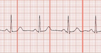 Basic ECG Rhythms