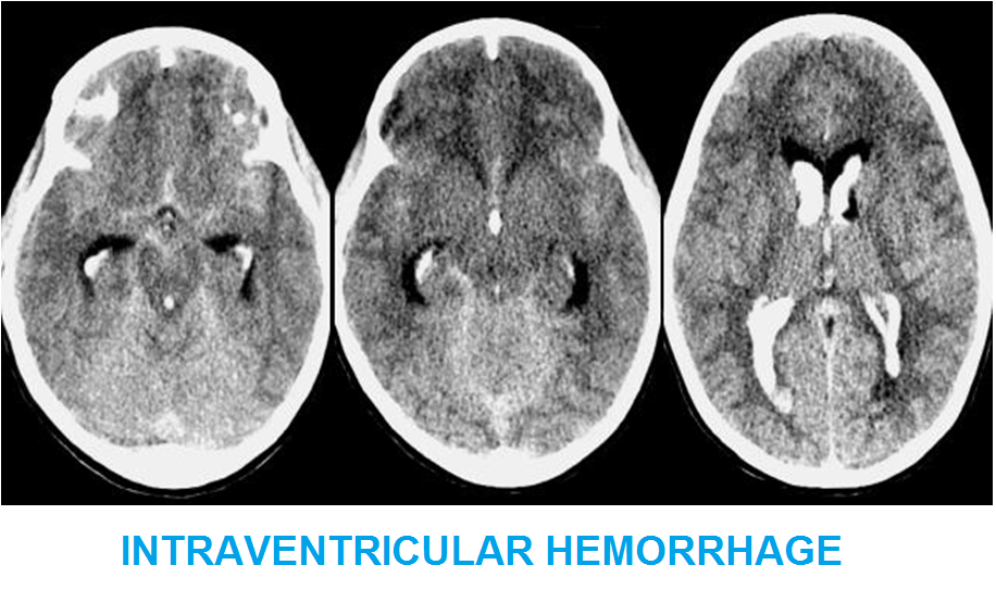 Intraventricular Hemorrhage Fig 2. | MR Imaging Of Hyperacute