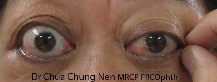 Eyelid Surgery by Prof Dr CN CHUA 蔡鐘能: A hyperthyorid patient with eye ...