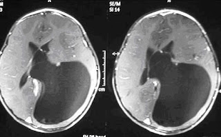 Neurosurgeon India: Left hemispheric porencephalic cyst with raised ICP