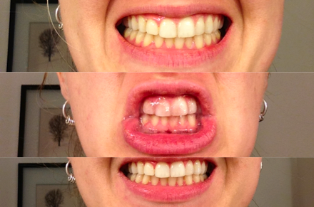 Whimsiful: strawberry teeth whitener