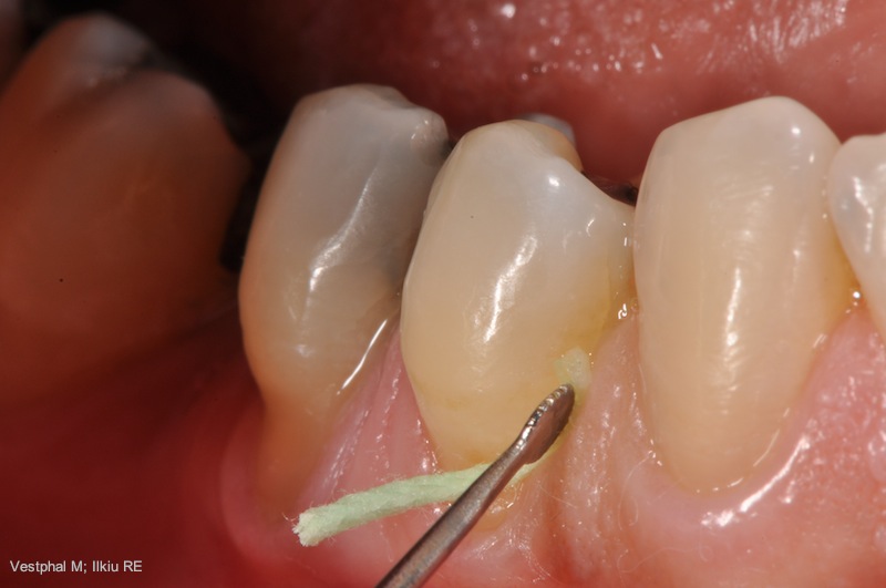 M. Vestphal - Odontologia Estética: Restauração Classe V com Resina ...