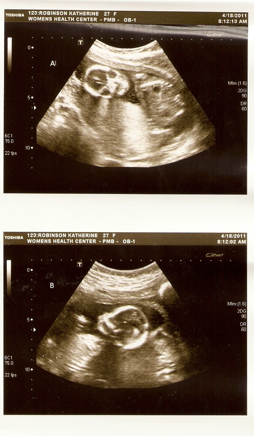 Sundstrom Robinson Family: 17 week ultrasound