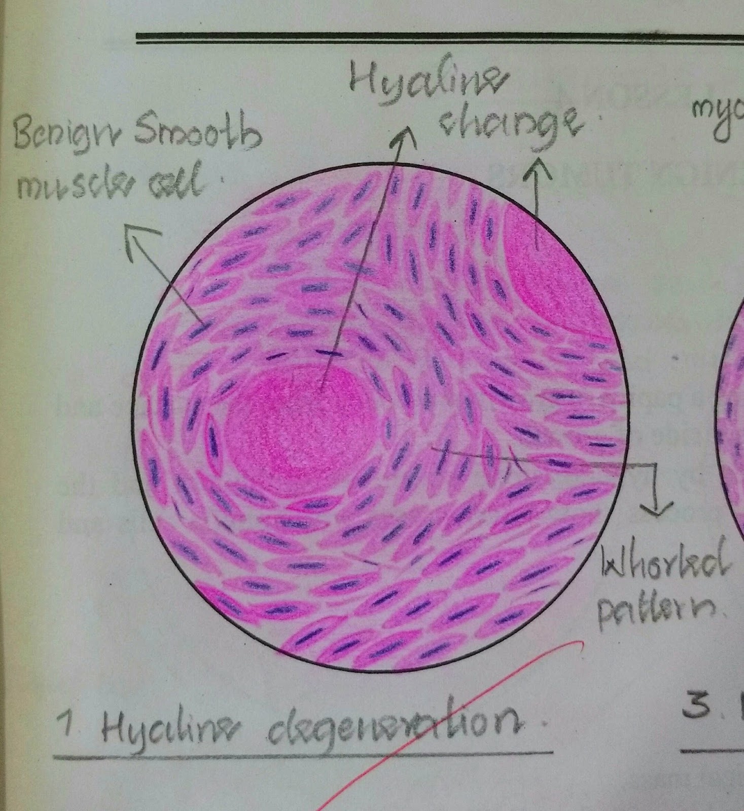 Histopathology Drawings: Hyaline degeneration