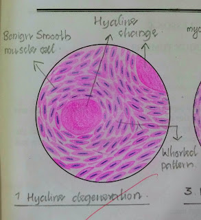 Histopathology Drawings: Hyaline degeneration