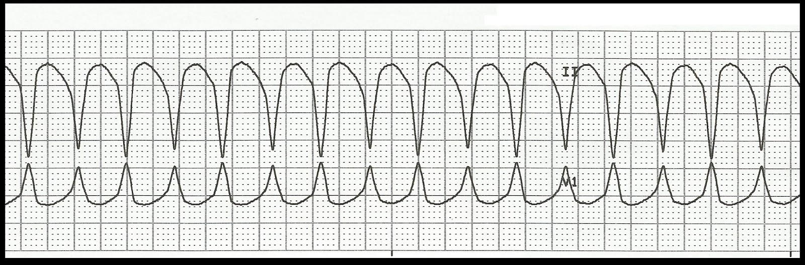EKG Rhythm Strip Quiz 153