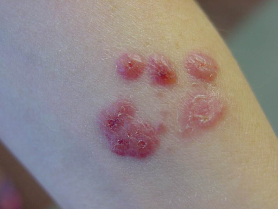 Teaching Dermatology Specialist Trainee Edition: Vesicles and Blisters