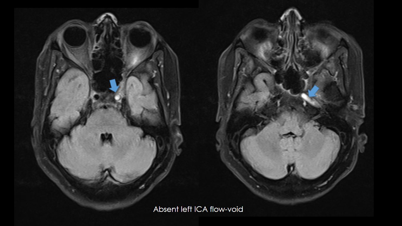 Ultimate Radiology : Diffusion negative Acute Infarct !! (False ...