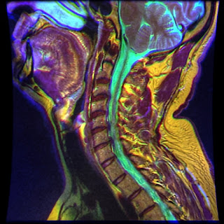 Nevit's blog: Color MRI of the Cervical Spine
