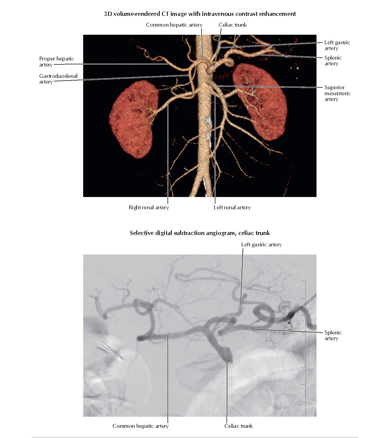 Celiac Arteriogram and CT Angiogram Anatomy - pediagenosis
