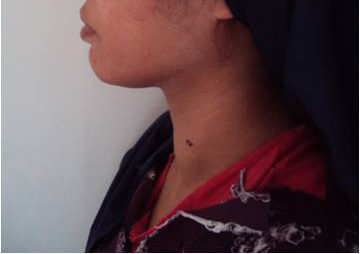 BEDAH UMUM FKUI: Prosedur MIVAT pada penatalaksanaan Nodul Tiroid