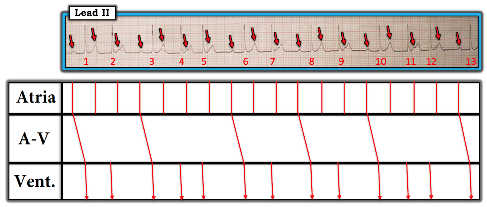 ECG Interpretation: ECG Blog #164 (PACs — Blocked PACs — Wenckebach ...