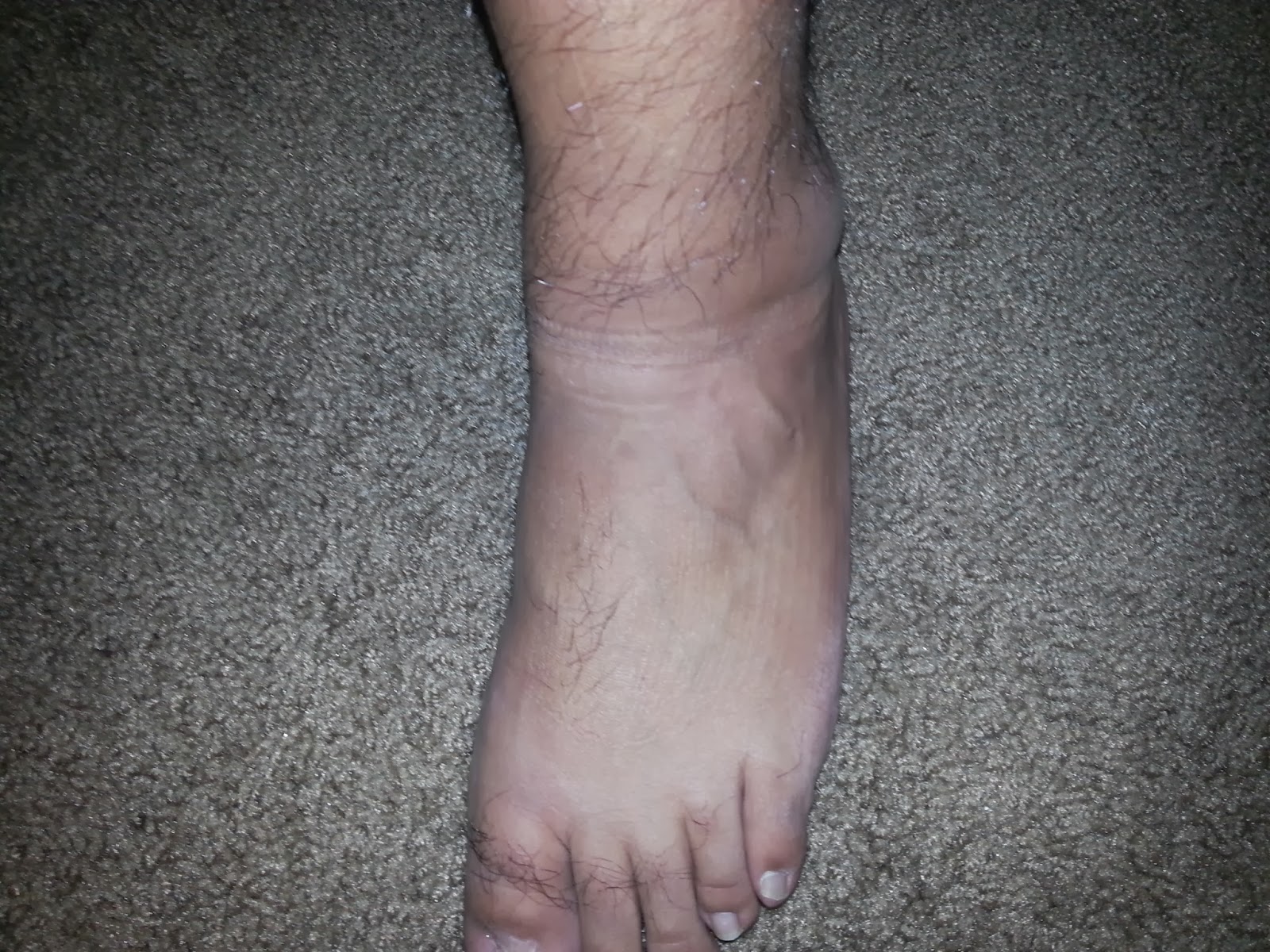 Peroneal Tendon Surgery Recovery: Ankle Time Line (updated for week 10/11)