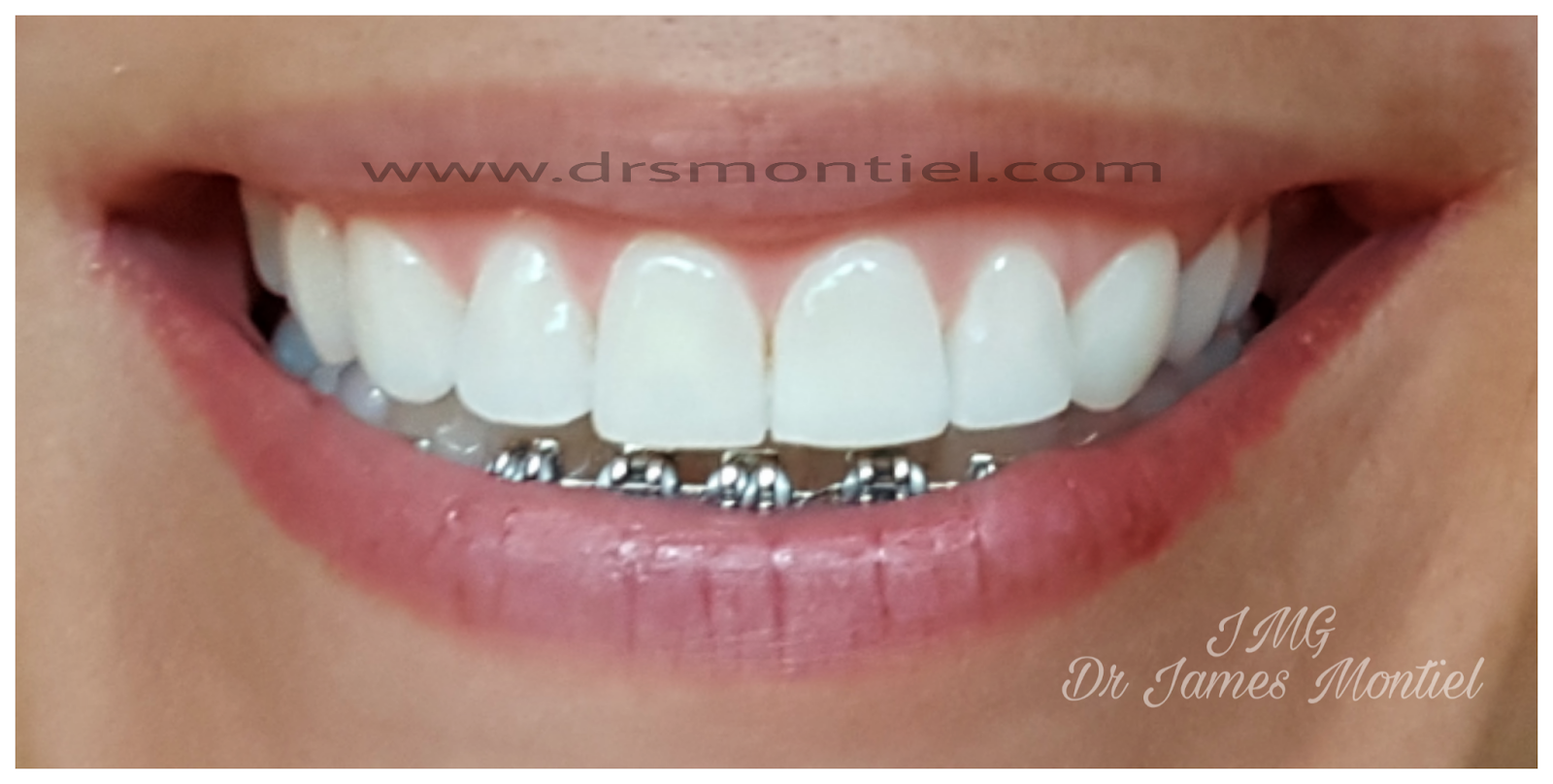 Botox, Acido Hialurónico, Bichectomia, Invisible Touch Hilos Pdo