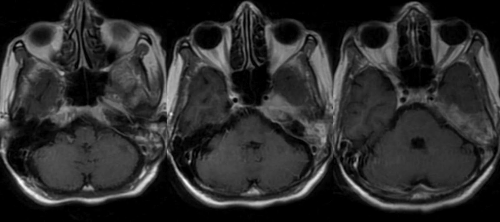 Dr Balaji Anvekar FRCR: Gradenigo's syndrome MRI