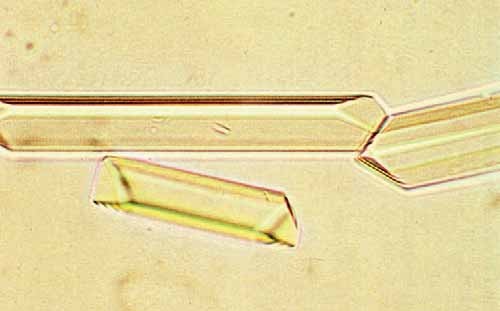 Atlas of Crystals found in alkaline urine | Free Medical Atlas