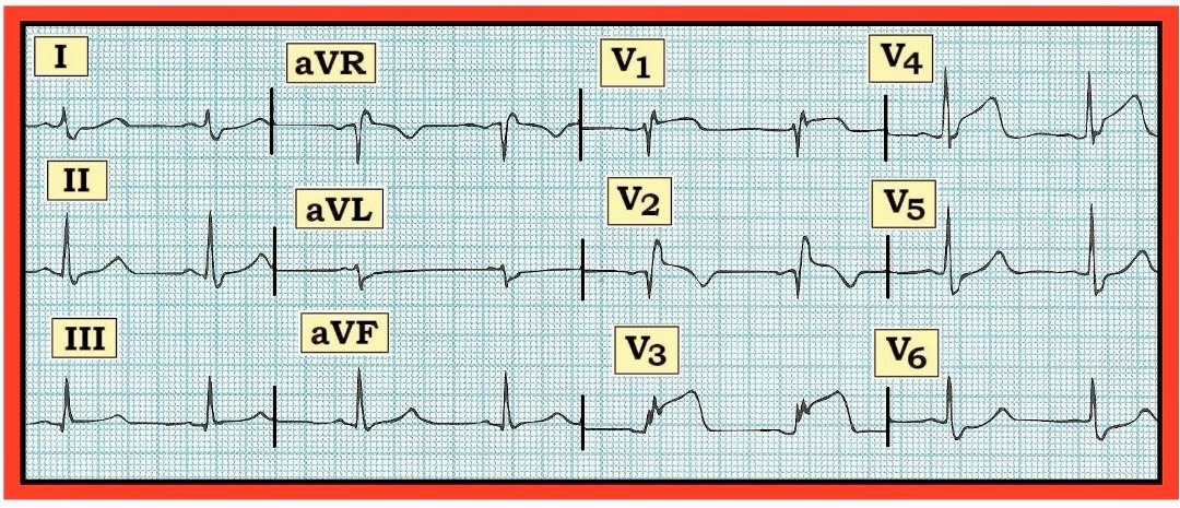 ECG Interpretation: ECG Interpretation Review #82 (Acute STEMI – RCA ...
