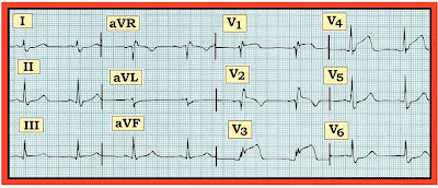 ECG Interpretation: ECG Interpretation Review #82 (Acute STEMI – RCA ...