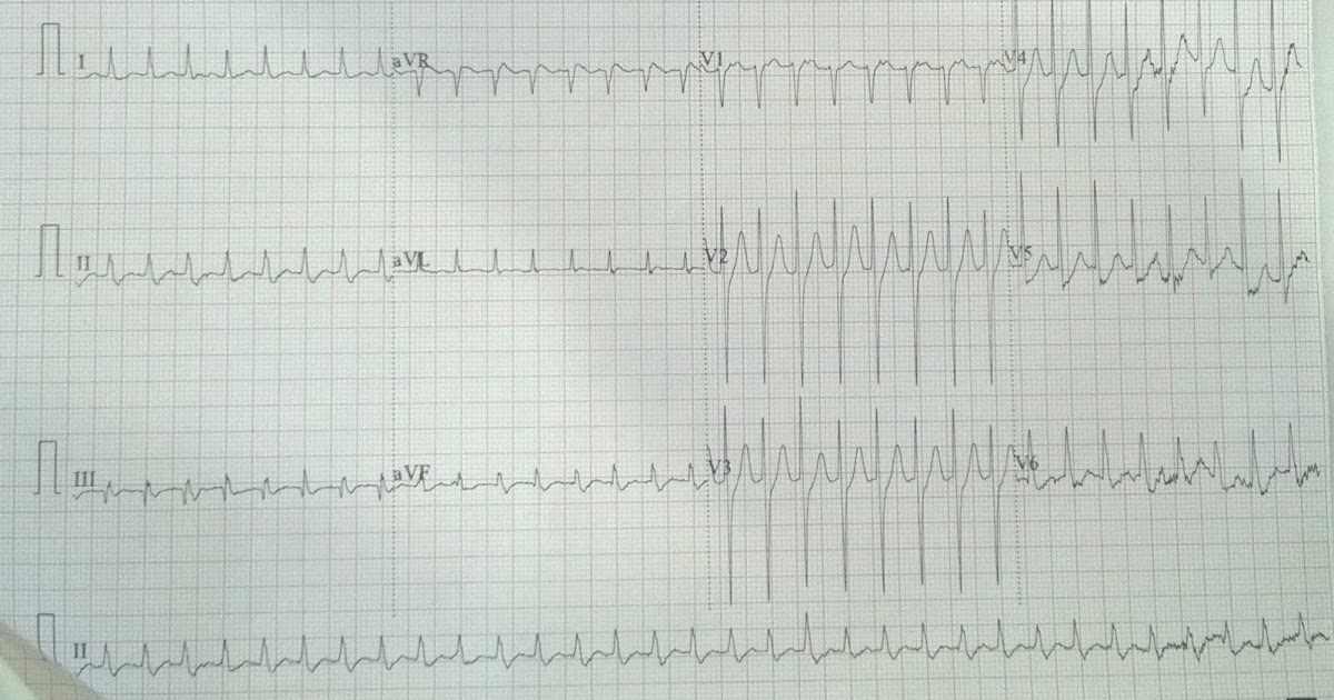 Cardiology window: AVRT