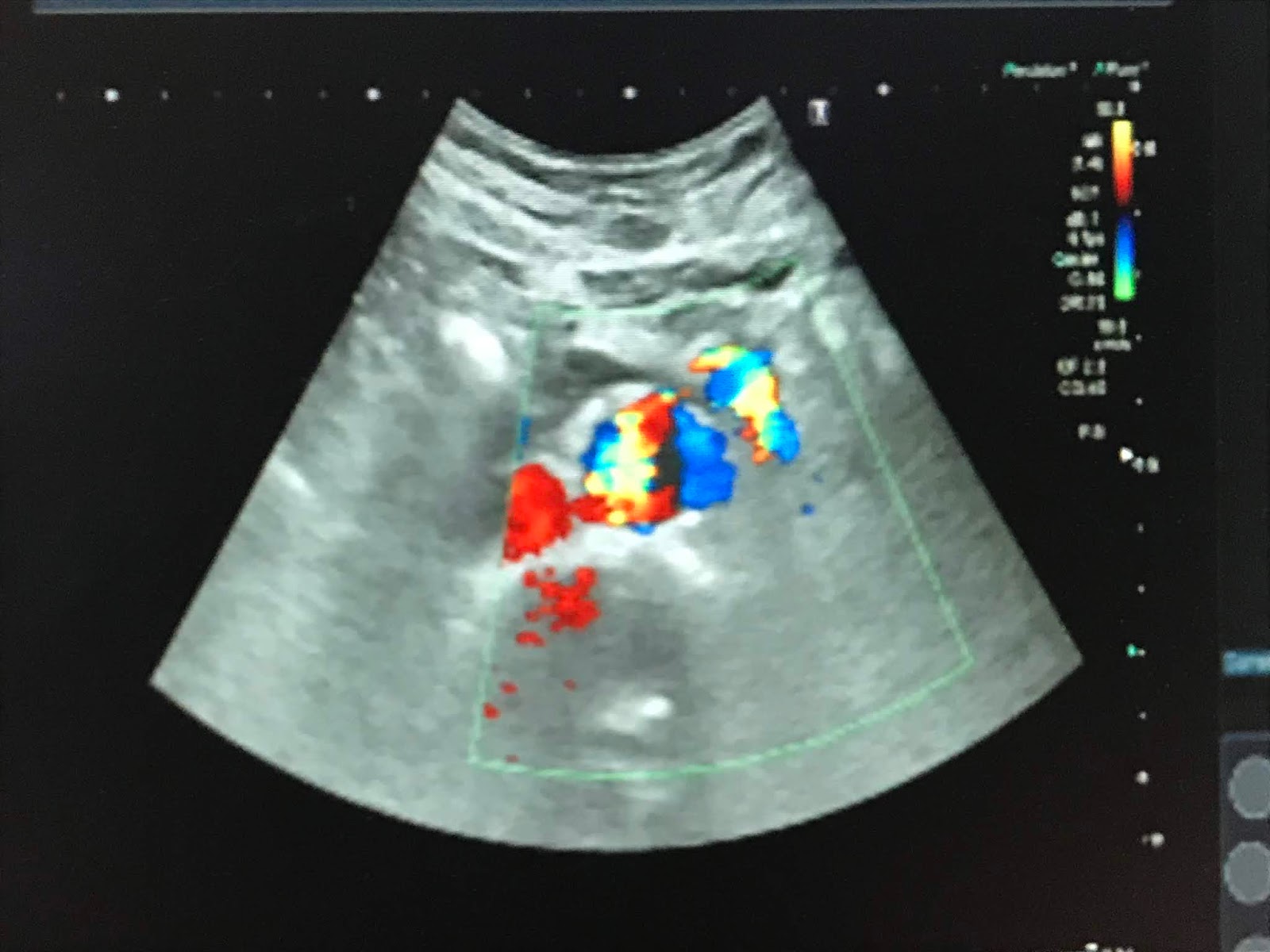 VIETNAMESE MEDIC ULTRASOUND: CASE 545: AORTIC DISSECTION, Dr PHAN THANH ...