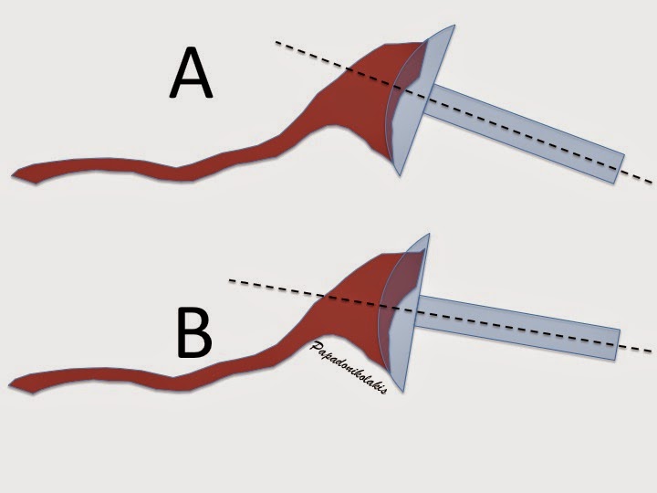 Shoulder and Elbow Surgery: How to ream a biconcave glenoid and when to ...