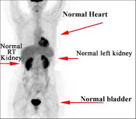 My Voice: Imaging for detection and follow up (MRI, PET, and CT scans ...