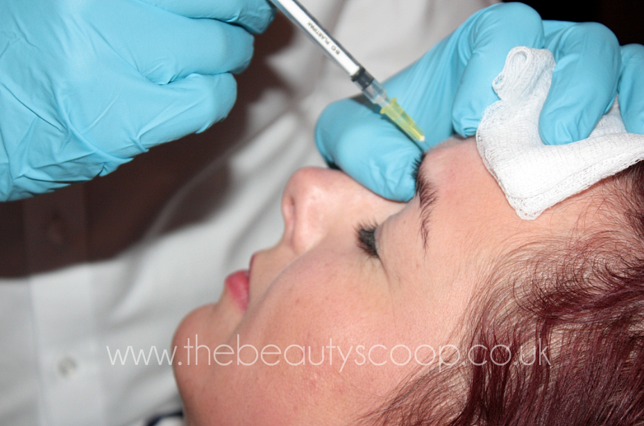 The Beauty Scoop!: The Botox Diaries - Days 1 to 4!