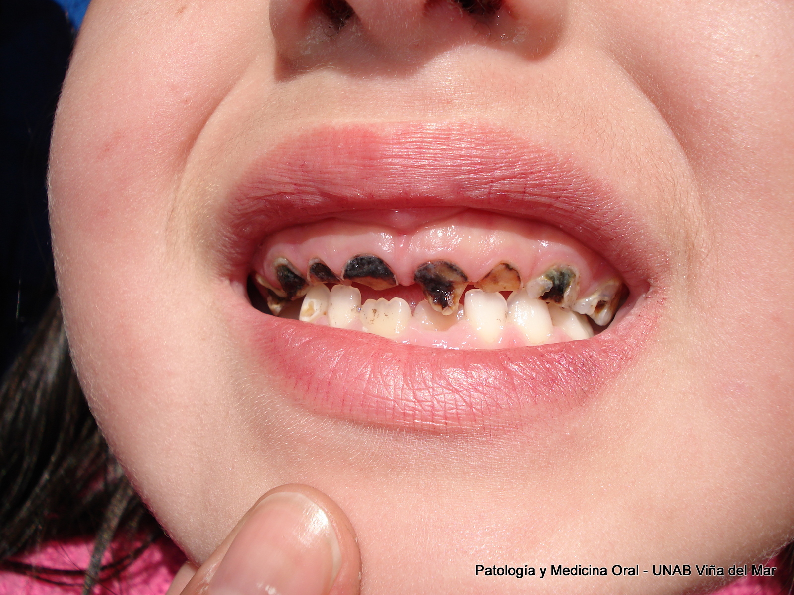 Estomatología Integral III: LA CARIES RAMPANTE O ENFERMEDAD DEL BIBERON