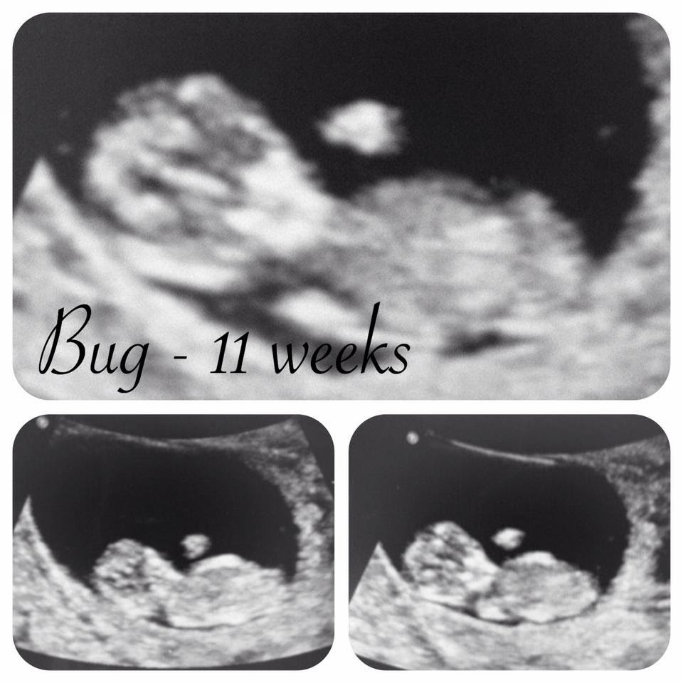 11 Weeks 4 Days - Symptoms & Heartbeat/Ultrasound Appointments