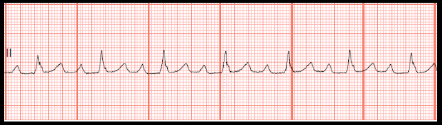 Heart Block Quiz 299