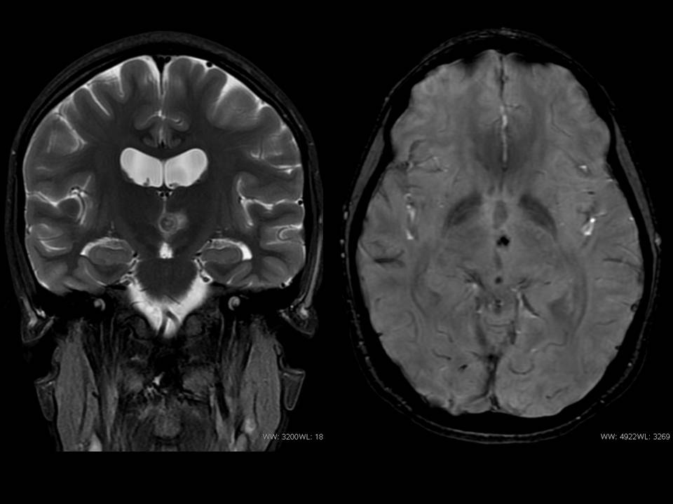 Radshare: Cavernous Angioma of Brain