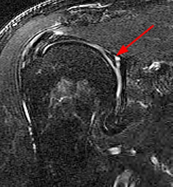 MRI Musculo-Skeletal Section: Labrum