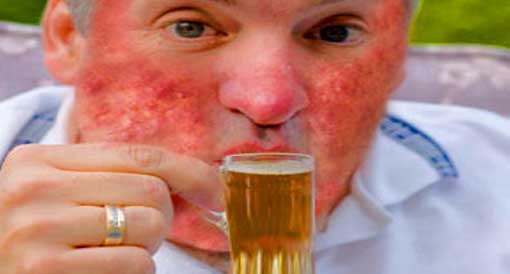 5 Myths About Rosacea - NikiHow