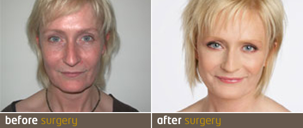 Mini Facelift: Understand the Difference of an S Lift Surgery and the ...