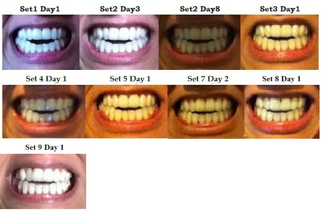Invisalign For Severe Anterior Open Bite - My Pictures and Story: Tray ...