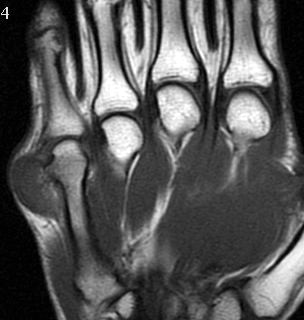 BPOP versus differentials - Sumer's Radiology Blog