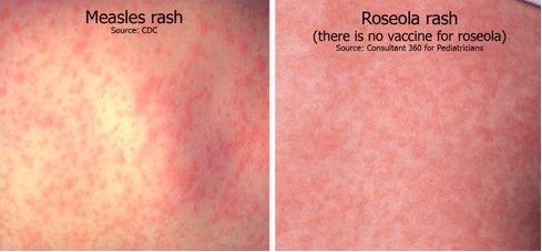 Perbedaan Campak Dengan Roseola - Pasien Sehat