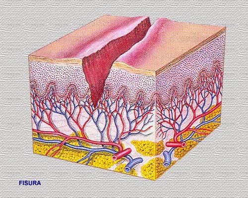 Mis blogs: LESIONES ELEMENTALES (4)