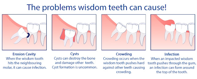 Dr. Dante Gonzales' Blog: What You Need to Know About Wisdom Teeth