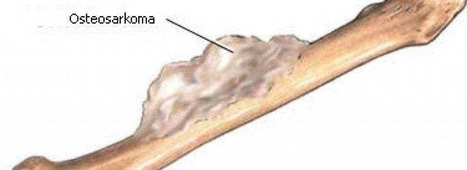 Le cancer des os - Symptômes et cancer des os types. - Articles à ...