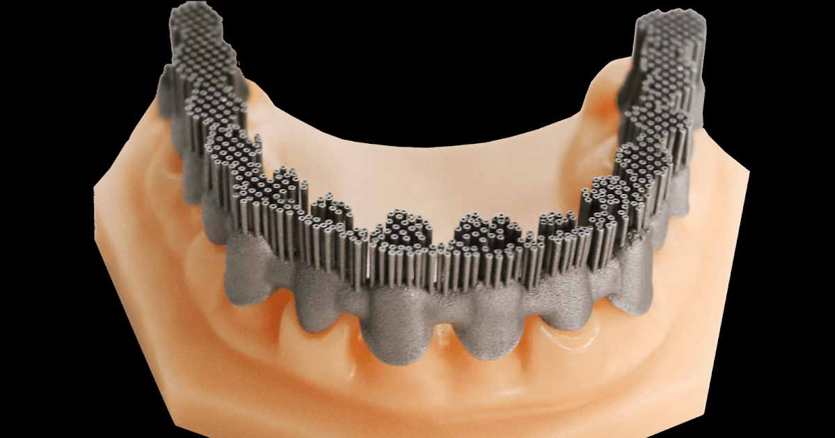 Palmary Implant Dental Laboratory Co., Ltd.: Digital Crown & Bridge ...